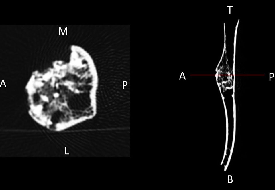 Svulst i armen til ung jente er Mellom-Amerikas eldste funn av kreft ...
