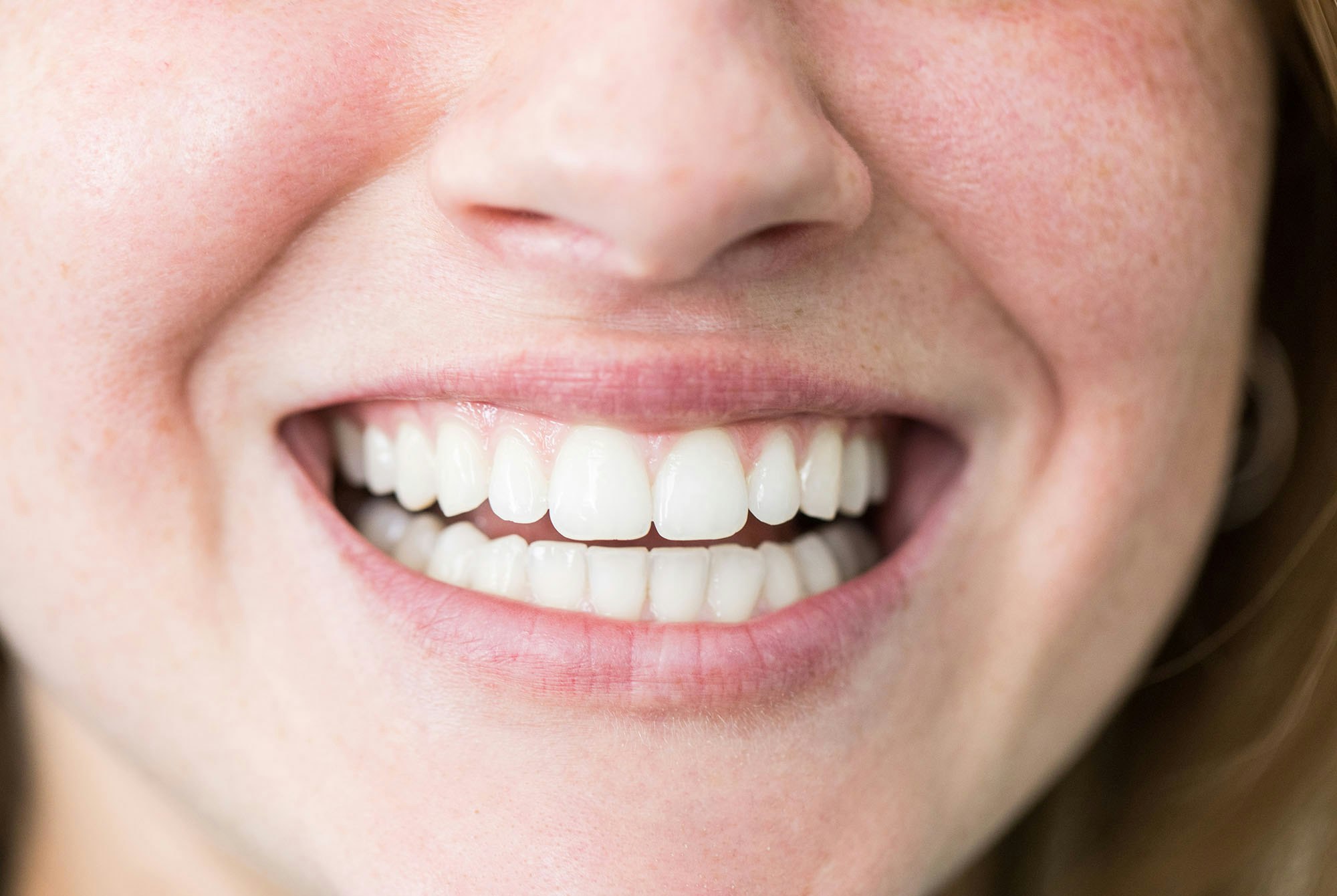 Ovatko valkoiset hampaat aina terveemmät kuin värjäytyneet? | kuntoplus.fi