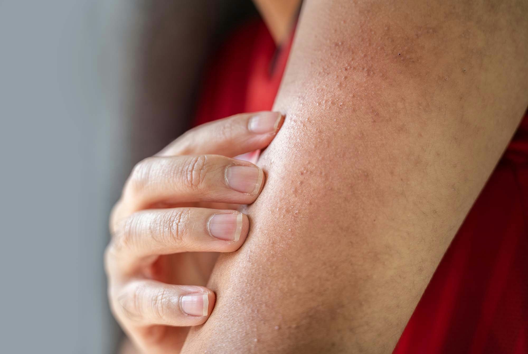Keratosis pilaris – slik blir du kvitt nuppene | iform.nu