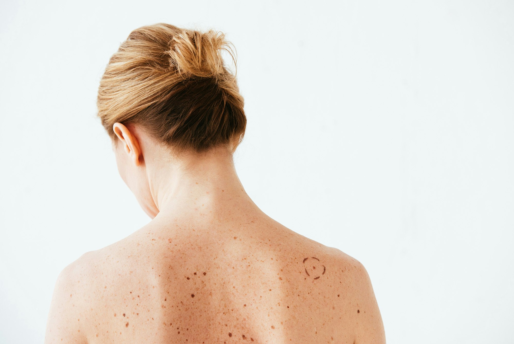 Lær deg forskjellen på hudkreft og føflekkreft | iform.nu