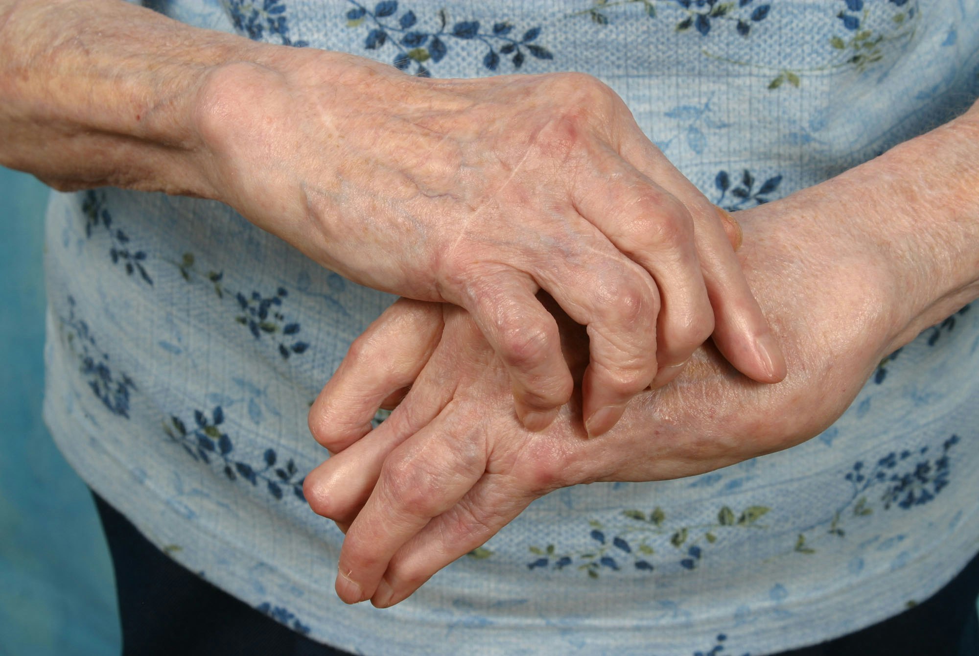 Artros i fingrarna: Symptom och behandling | iform.se