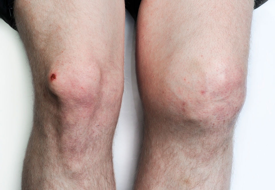 Stamceller kurerer giktrammede knær | illvit.no