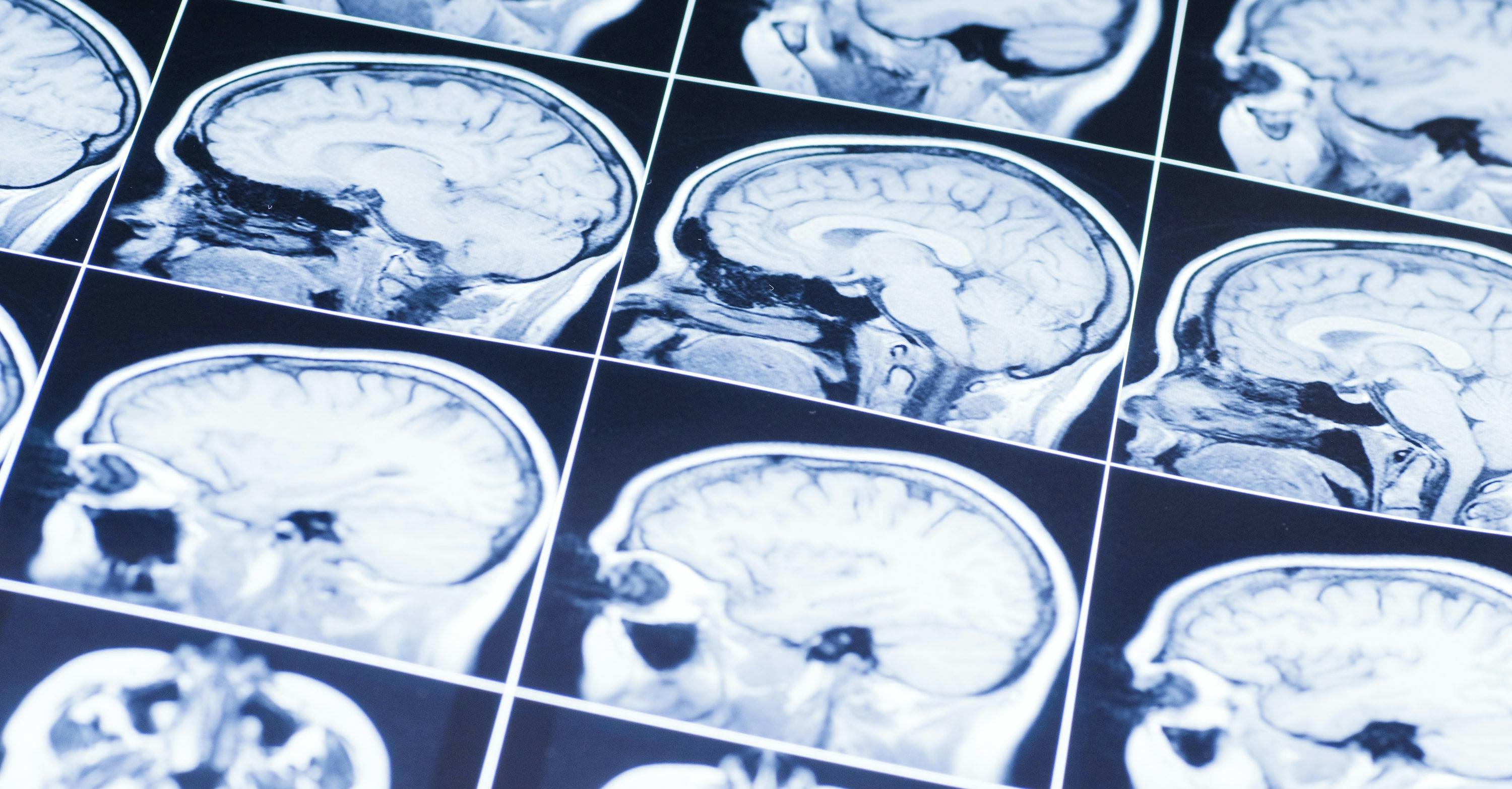 Mysterieuze ziekte is in de hersenen te zien | wibnet.nl