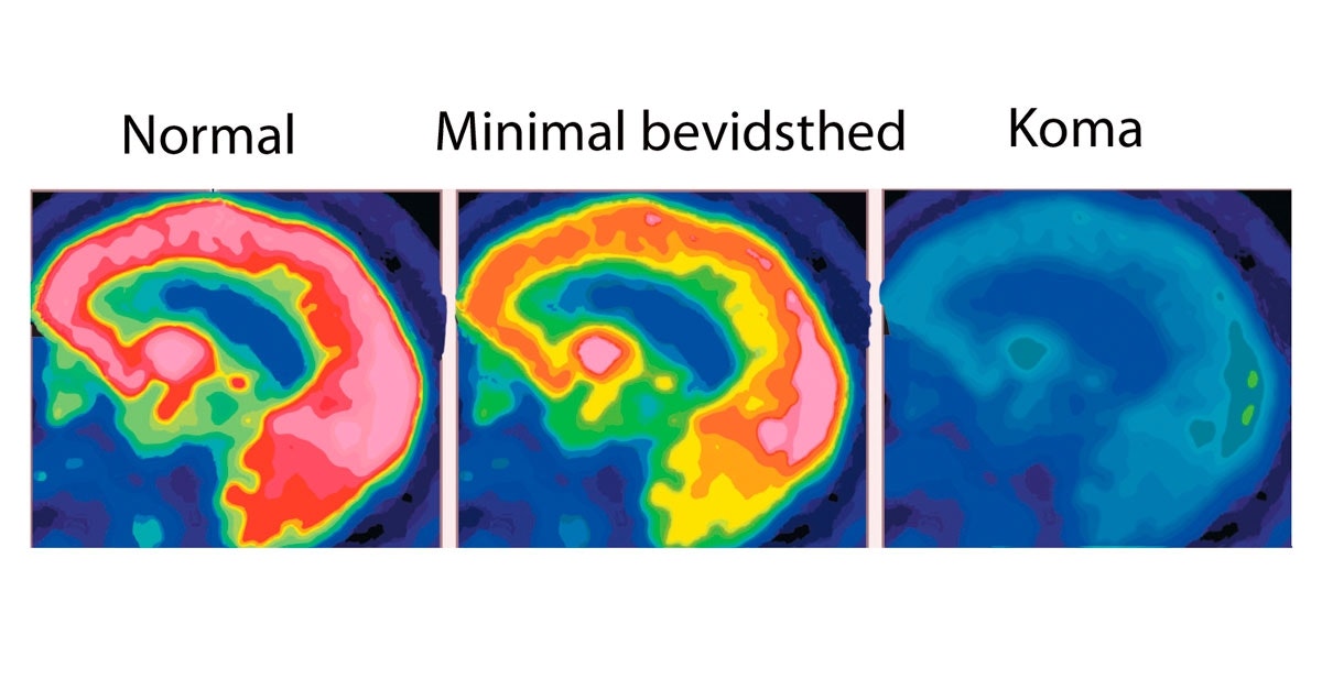 Hvad er kunstig koma? | illvid.dk