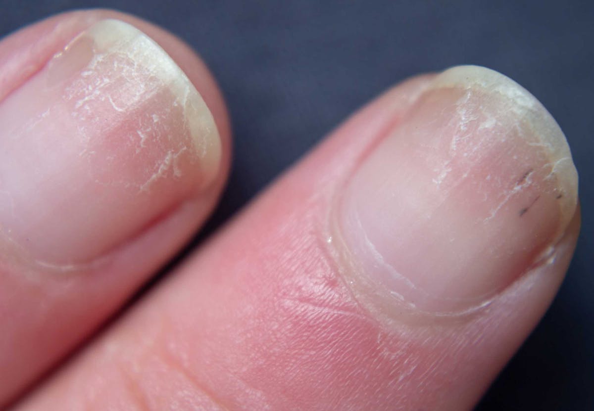 Varför spricker mina naglar?? Här är orsakerna. | illvet.se