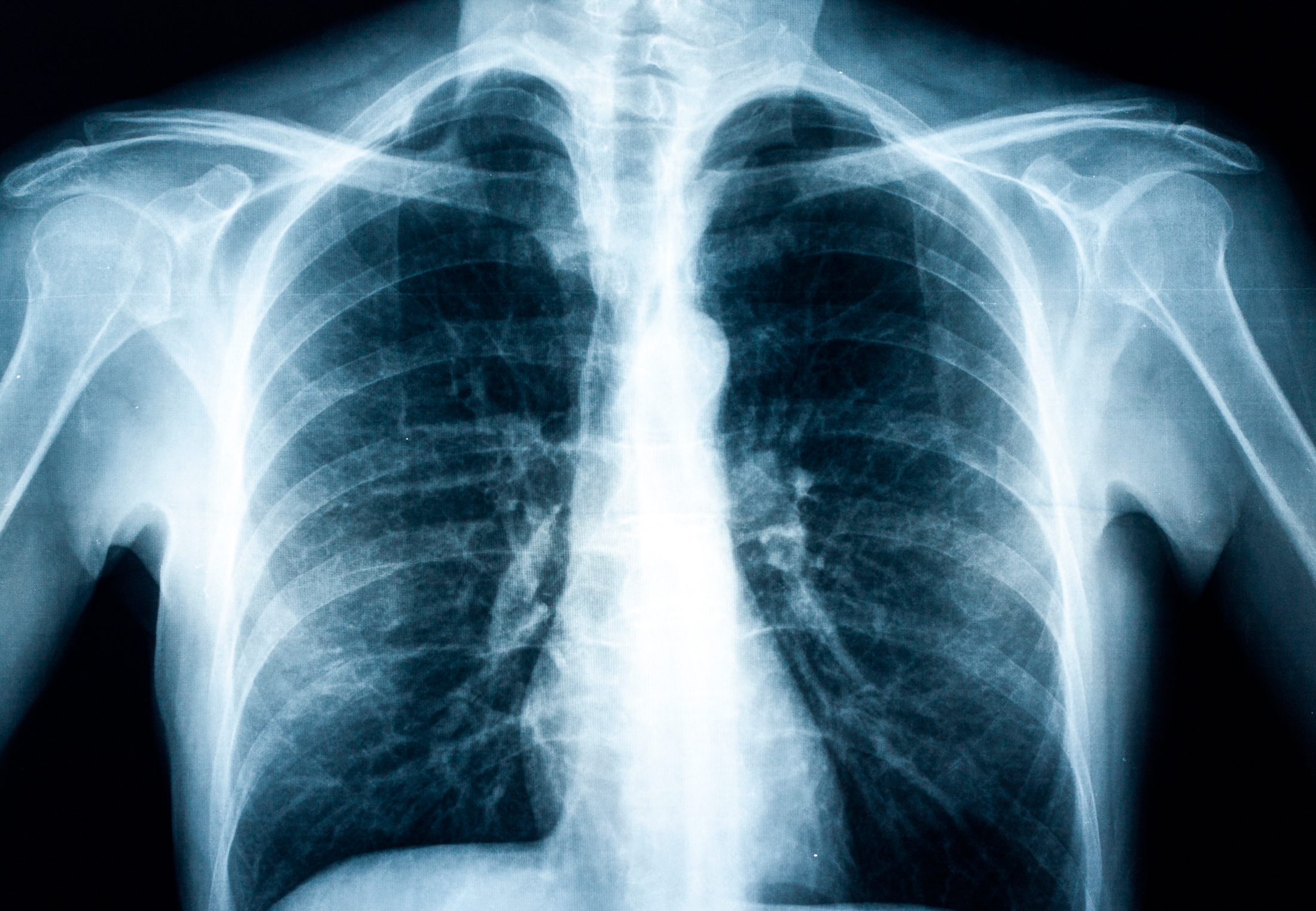 Hvor farlige er røntgenstråler? | Illvid.dk