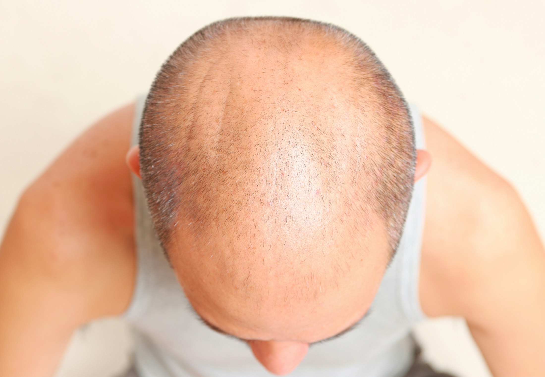 Hvorfor er det så mange menn som blir skallet? | illvit.no