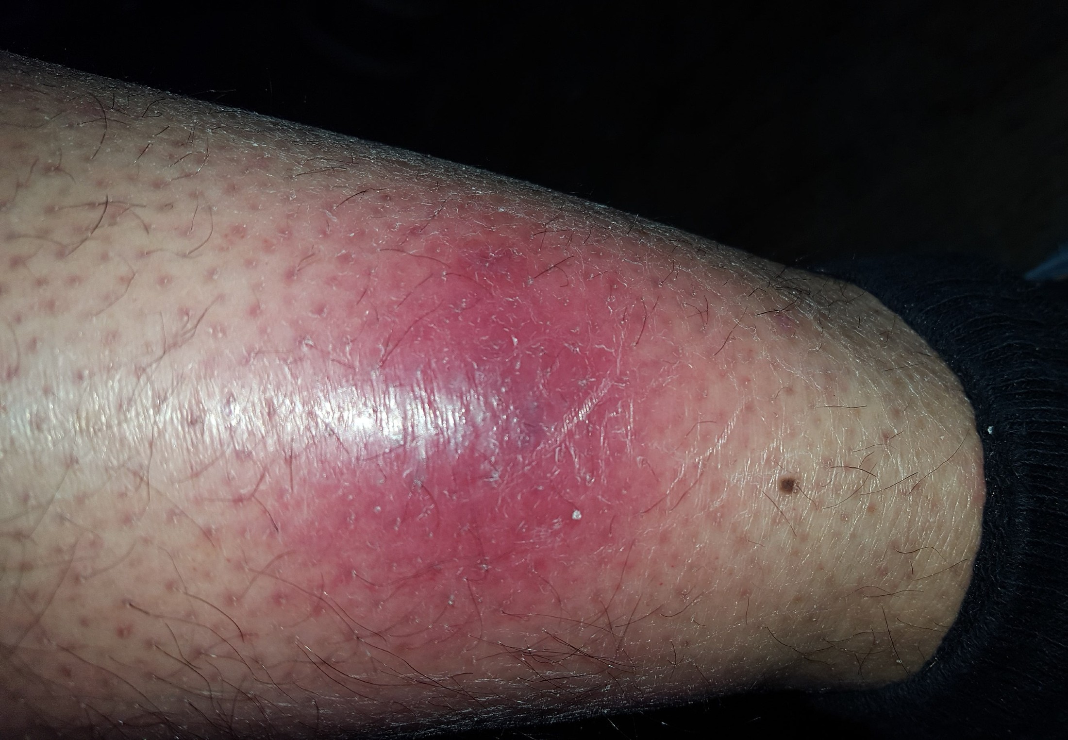 Staph Infeksjon Bakterier Staphylococcus Aureus Biofilm