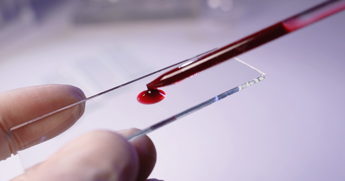 Uusi verikoe paljastaa syövän – ja leviämisasteen | tieku.fi