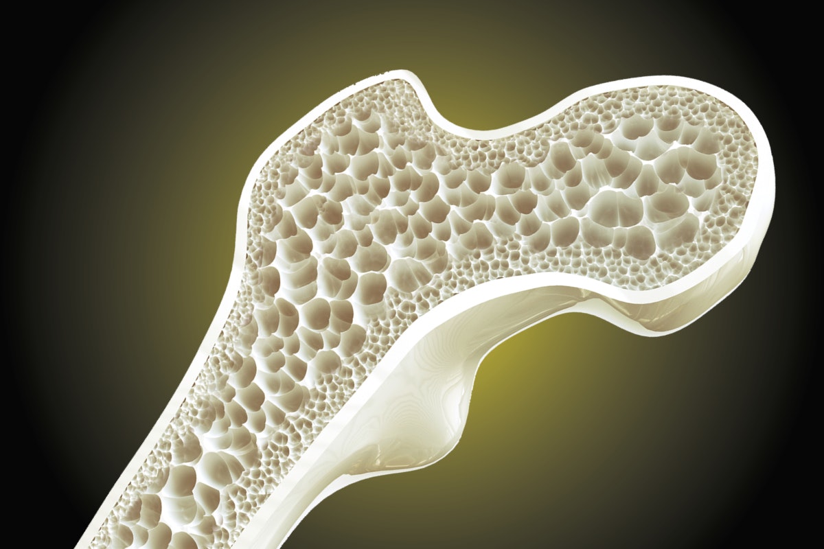 Osteoporose is een gebrek aan kalk en botweefsel | wibnet.nl