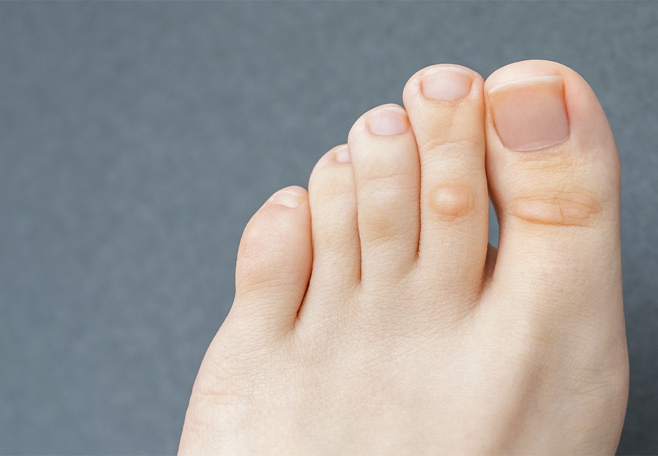 Hvordan fjerner man en ligtorn? Her er 4 simple tips | woman.dk