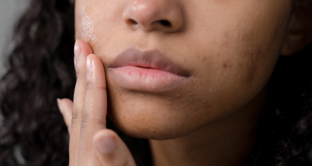 Døjer du med uren hud på kinderne? | woman.dk